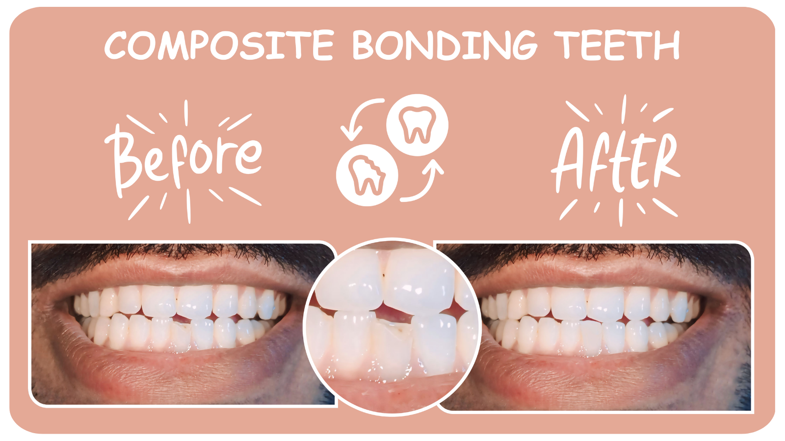 What is Composite Bonding Teeth - Dentist Bury St Edmunds, Mildenhall ...