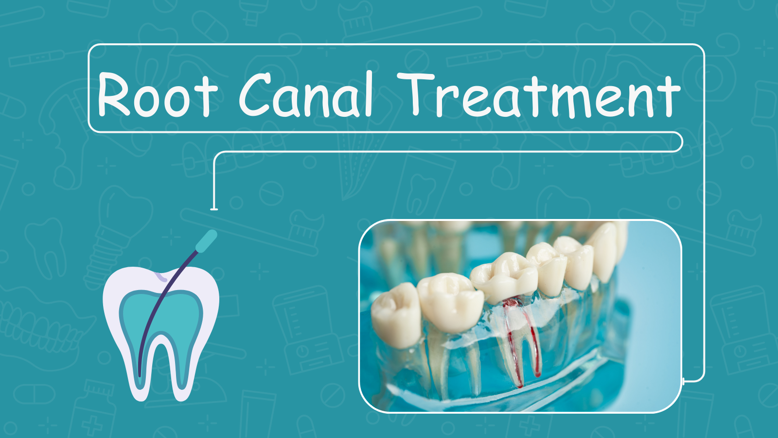 Root canal treatment side effects in bury st edmunds - Dentist Bury St ...